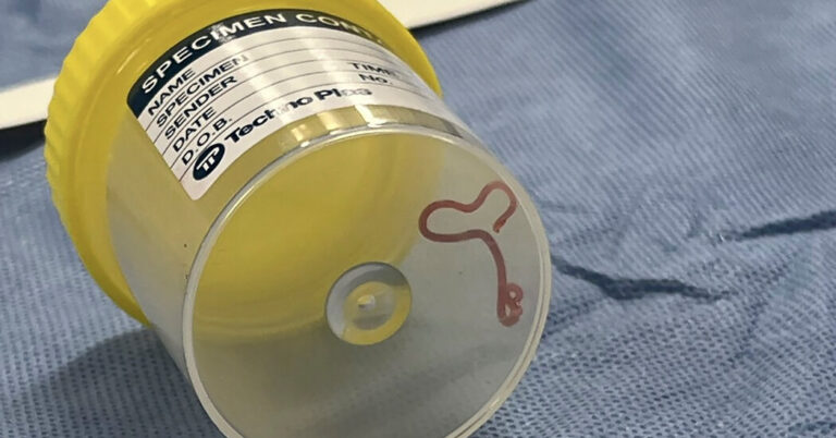Live 3-Inch Parasitic Worm Is Found in a Woman’s Brain During Surgery ...